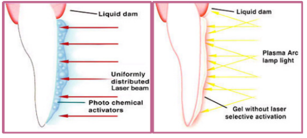 Photobleaching Using Lasers For Teeth Whitening In Dentistry