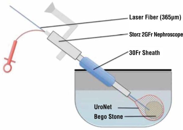 Laser Lithotripsy: Laser Treatment of Kidney Stones